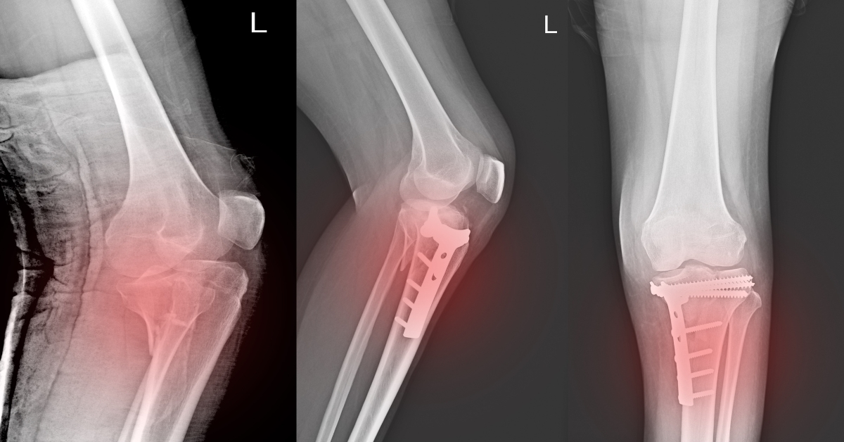 Severe Broken Bones or Fractures Er Houston | Heights Emergency Room
